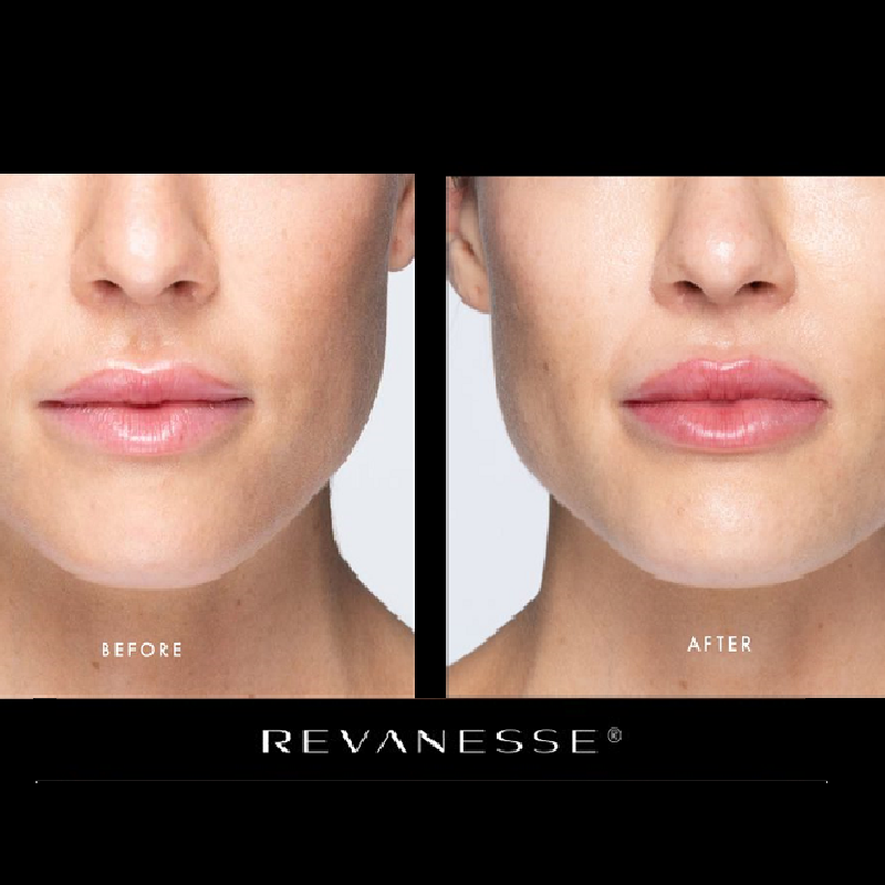 Versa Lip Filler - B You Medical